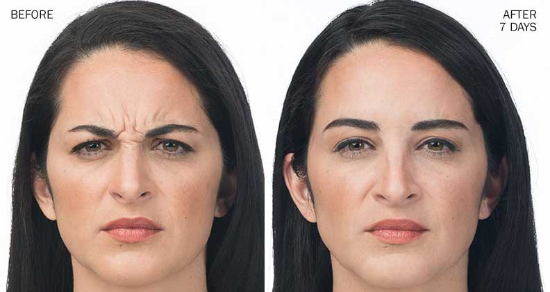 Botox for the Chin - Bunny Lines - Botox Toronto | Skin Vitality