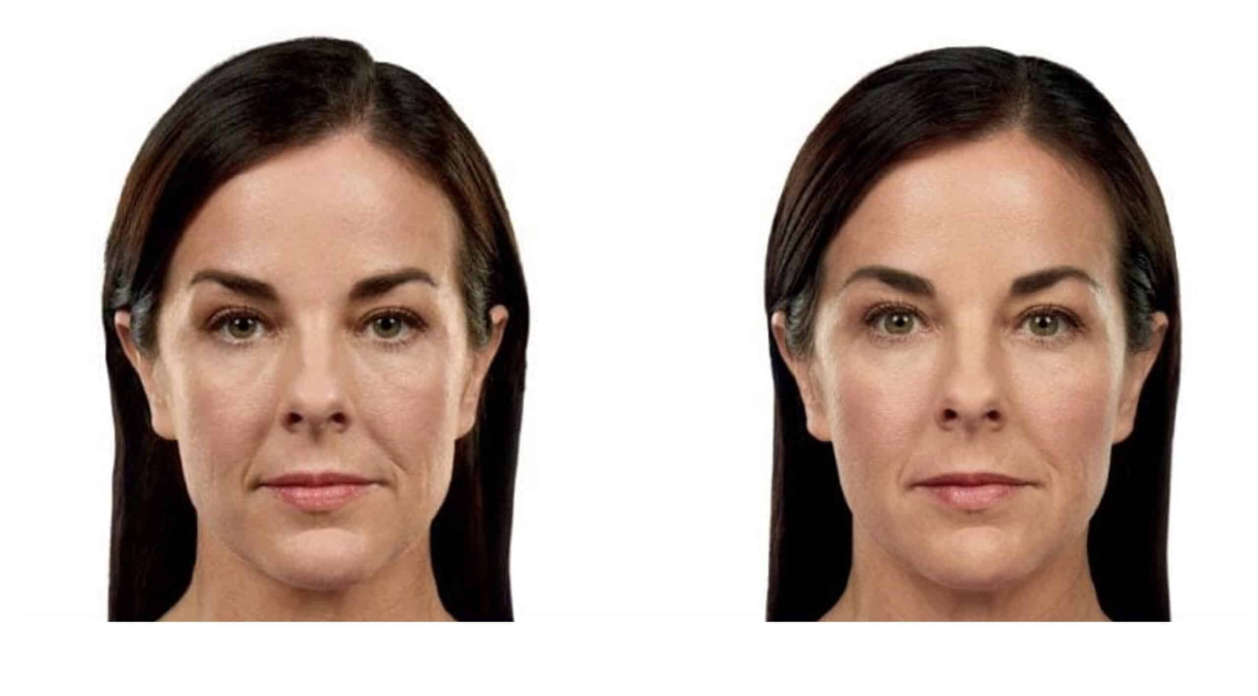 Cheek Fillers Toronto | Cheek Filler Cost Toronto | Fillers Toronto