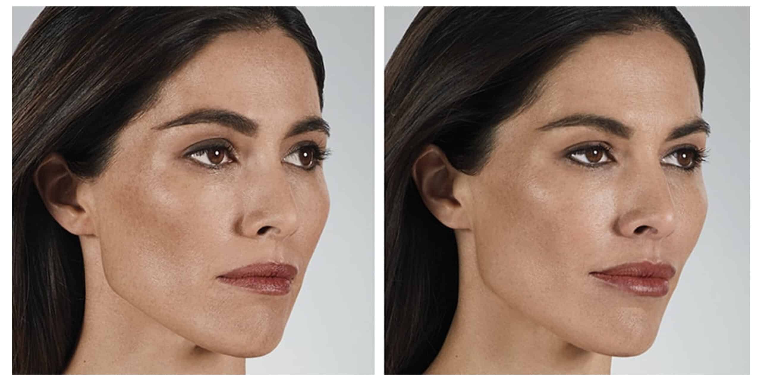 Cheek Fillers Toronto | Cheek Filler Cost Toronto | Fillers Toronto