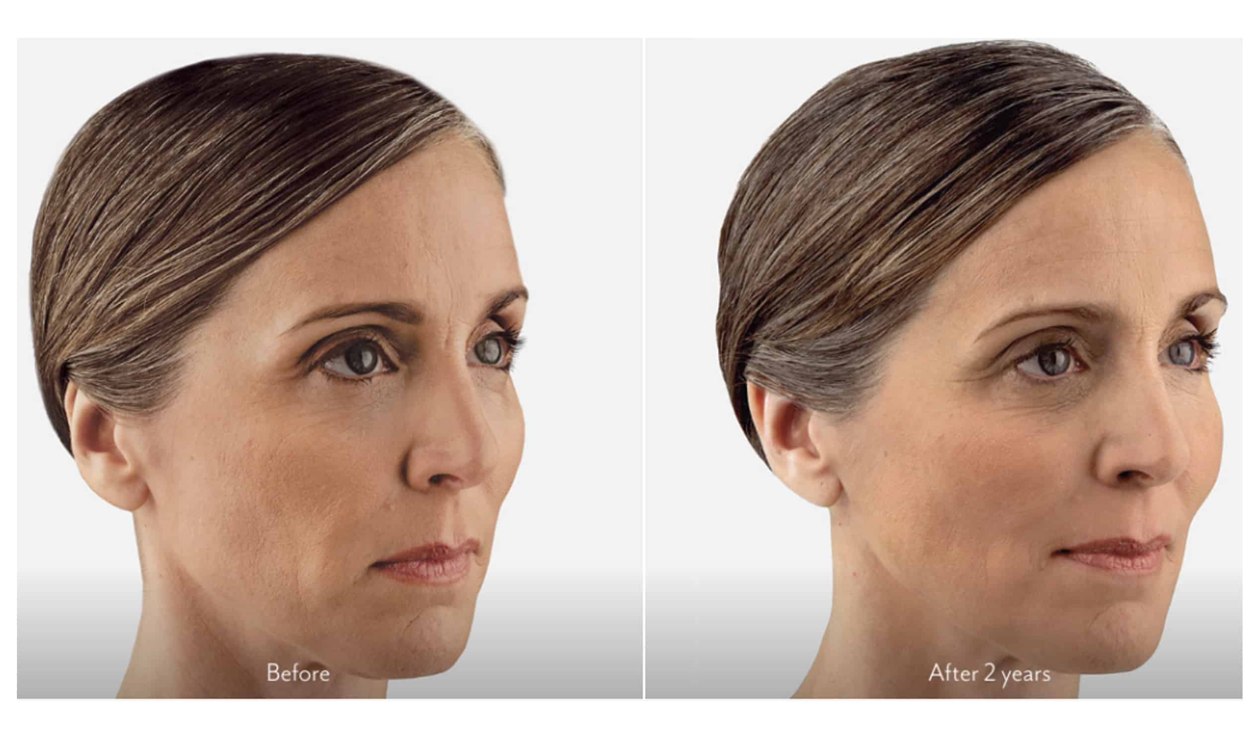 Cheek Fillers Toronto | Cheek Filler Cost Toronto | Fillers Toronto