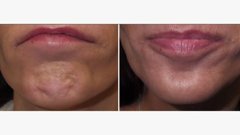 Botox for the Chin - Bunny Lines - Botox Toronto | Skin Vitality