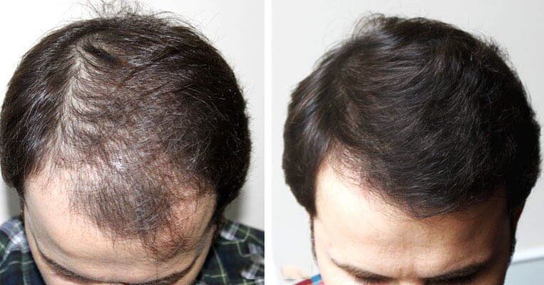 PRP Hair Treatment for Men Toronto | Mens PRP Hair Restoration Toronto ...