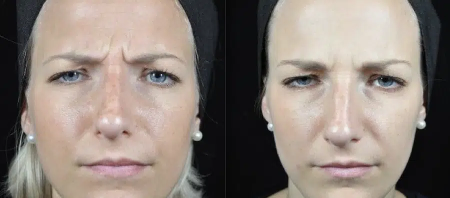 Micro-Botox / “Baby Botox”: Evidence, Technique, and Who It’s For