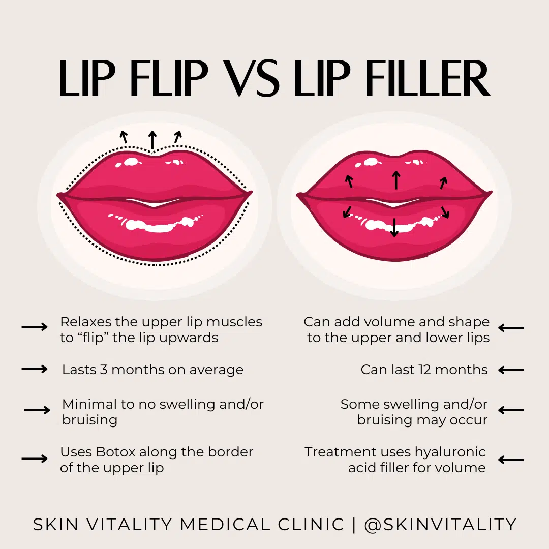 How Long a Botox Lip Flip Lasts: Week-by-Week Timeline
